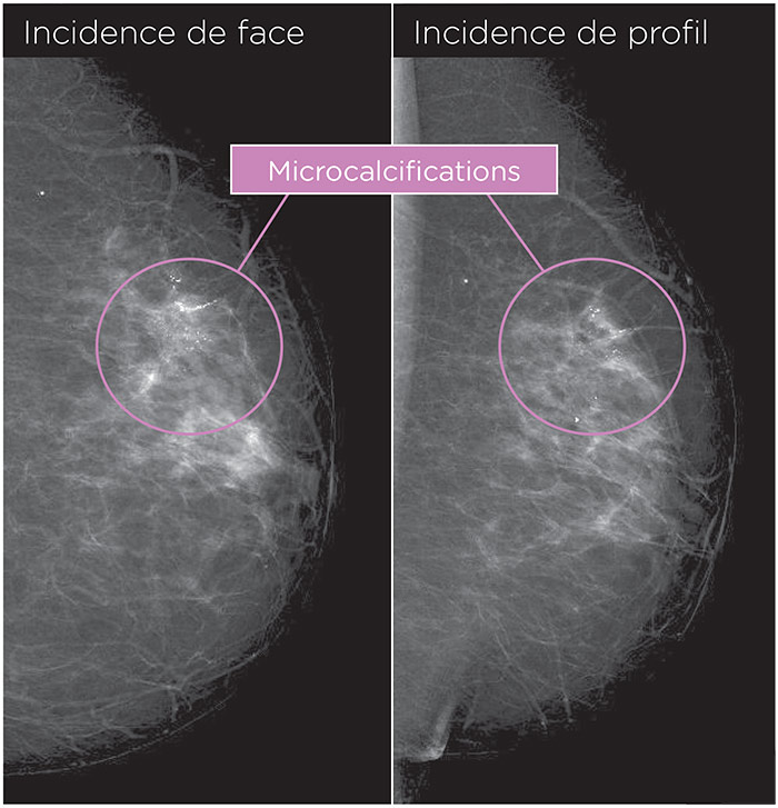 Macrobiopsie sur table dédiée ou pronetable | CHL